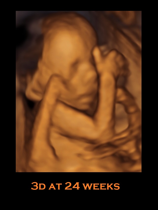 24 Weeks 3d Ultrasound